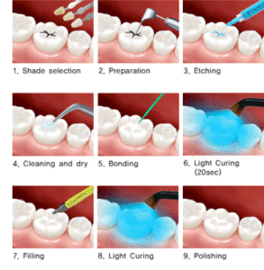 DENTAL FILLINGS - Skyline Family Dentistry | Grove St. Bishop