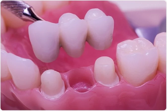 Dental Bridges Procedure Explained in Detail - Dentist in Bishop CA ...